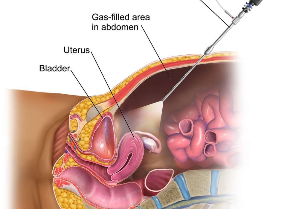 Laparoscopy - Fibroid, ovarian cyst, Endometriosis - Fertility Urology
